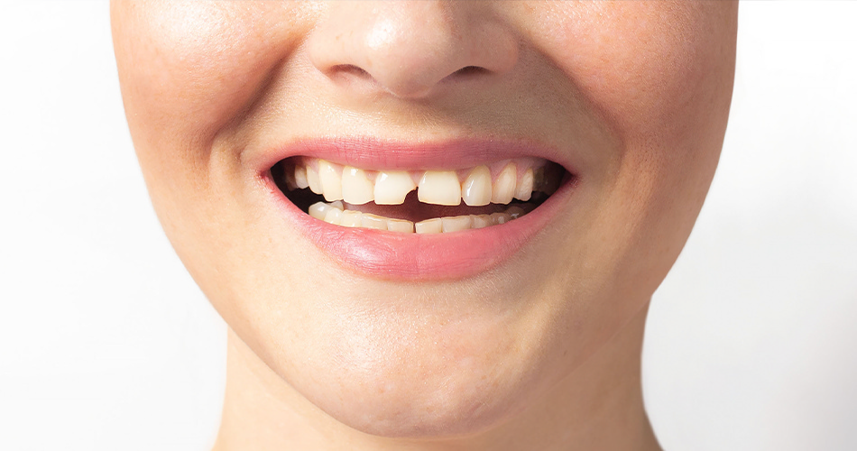 Har du knækket eller flækket en tand? Læs mere her | tandlægen.dk